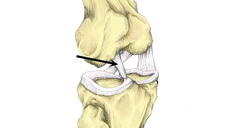 Ön Çapraz Bağ Yaralanmaları – Op.Dr. Serhan Kanevetci